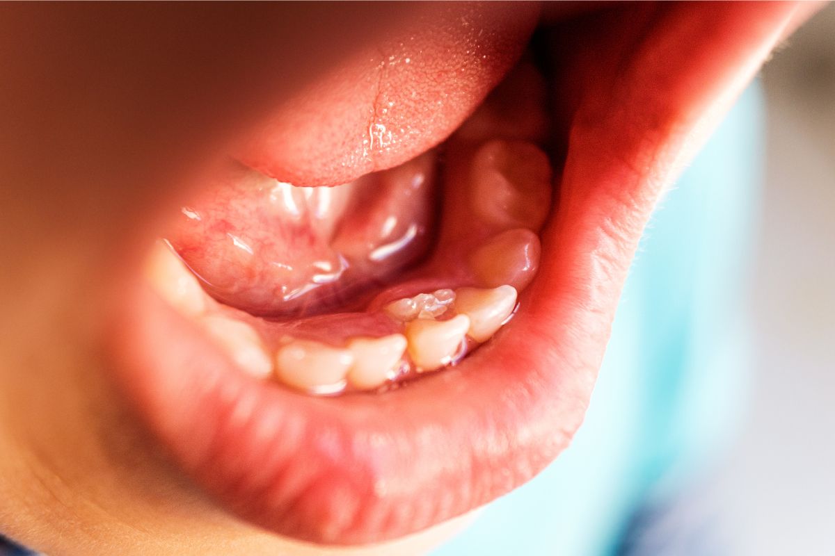 What Causes Shark Teeth in Children? | Pittsford Dentist Advice